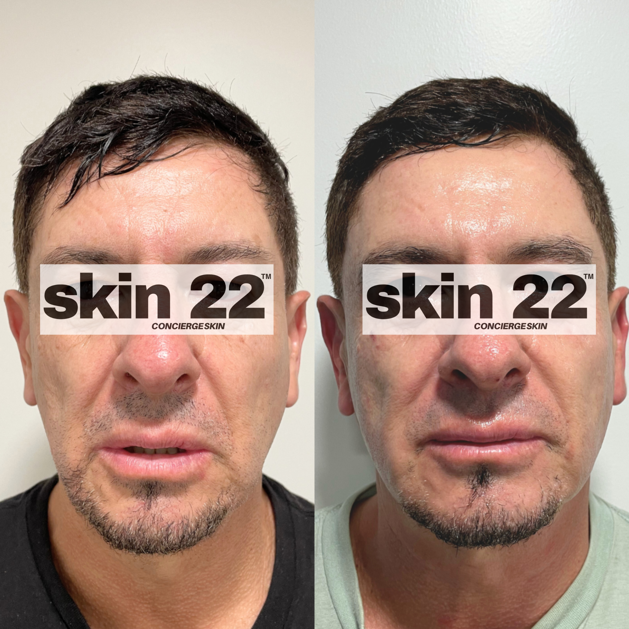 Sofwave Before and After: Real Results with Skin 22